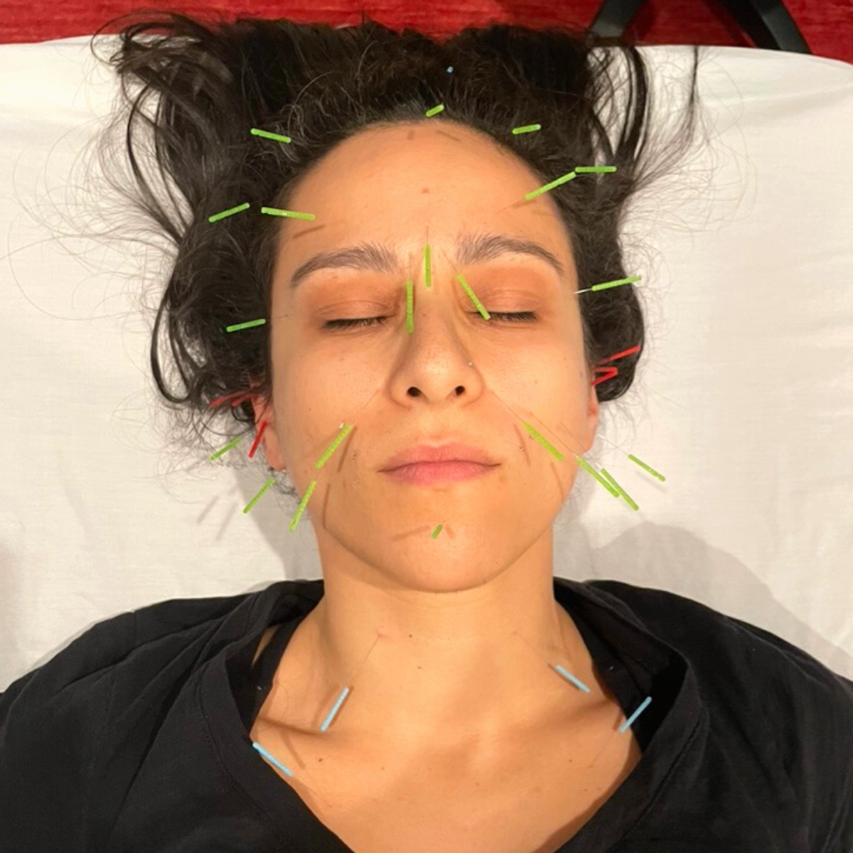 Facial Acupuncture Benefits Explained Holistic Skincare Liv